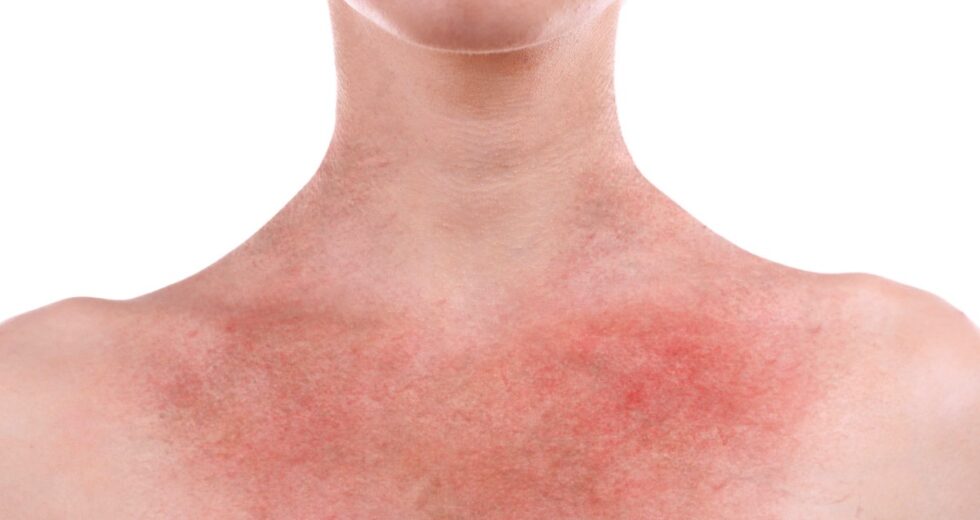 Poiquilodermia - Clínica Juliana Hypolito